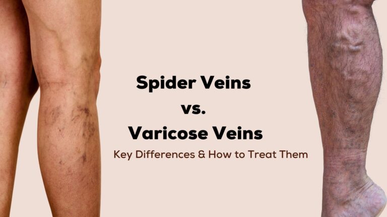 Spider Veins vs. Varicose Veins: Key Differences and How to Treat Them ...