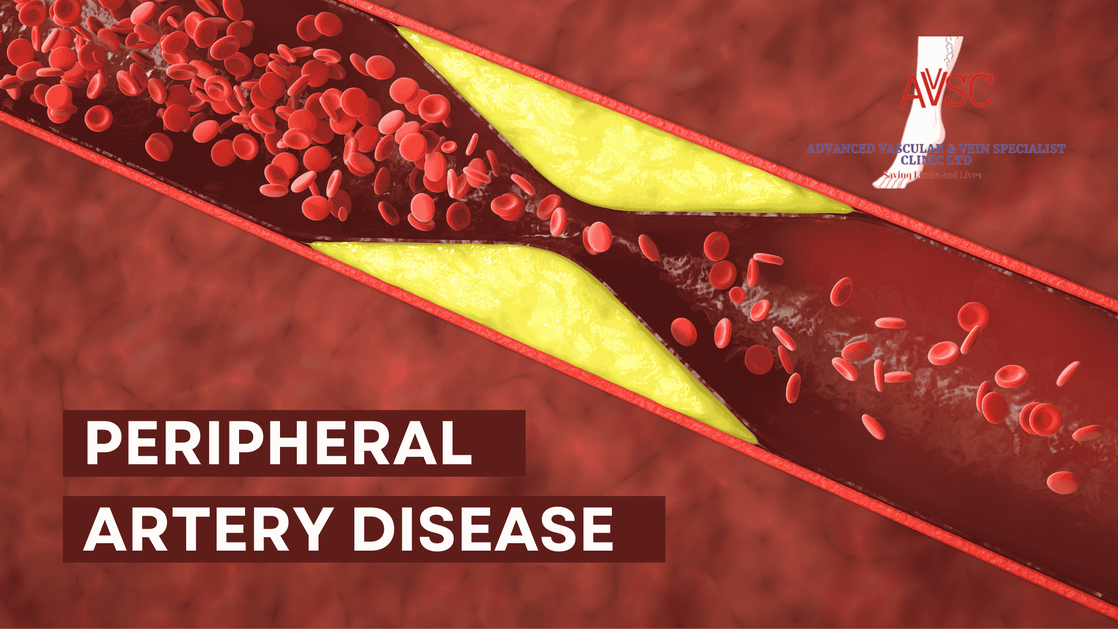 Peripheral Artery Disease: Early Detection and Management - Advanced ...