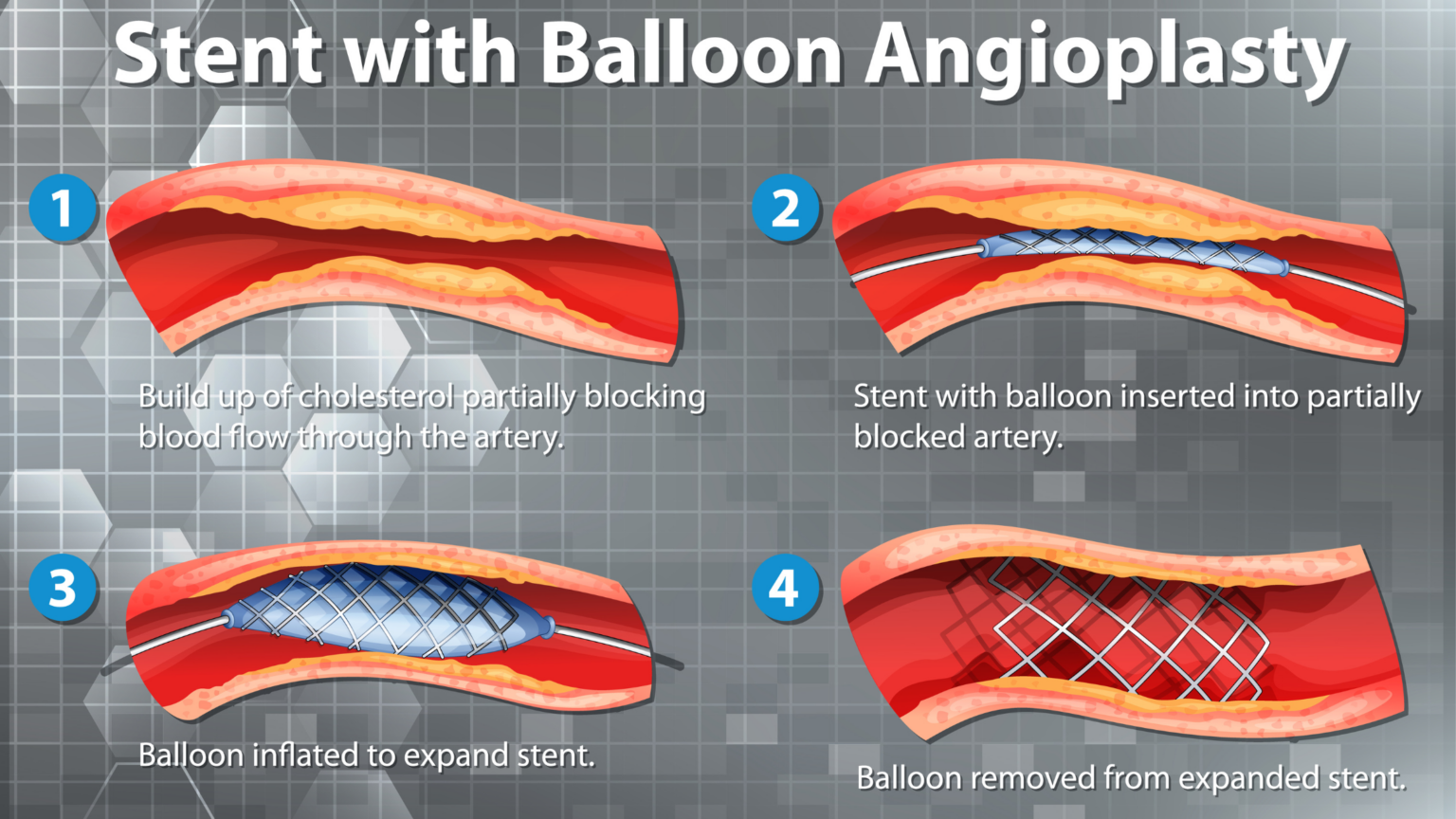 Peripheral Artery Disease (PAD) Treatment: Angioplasty