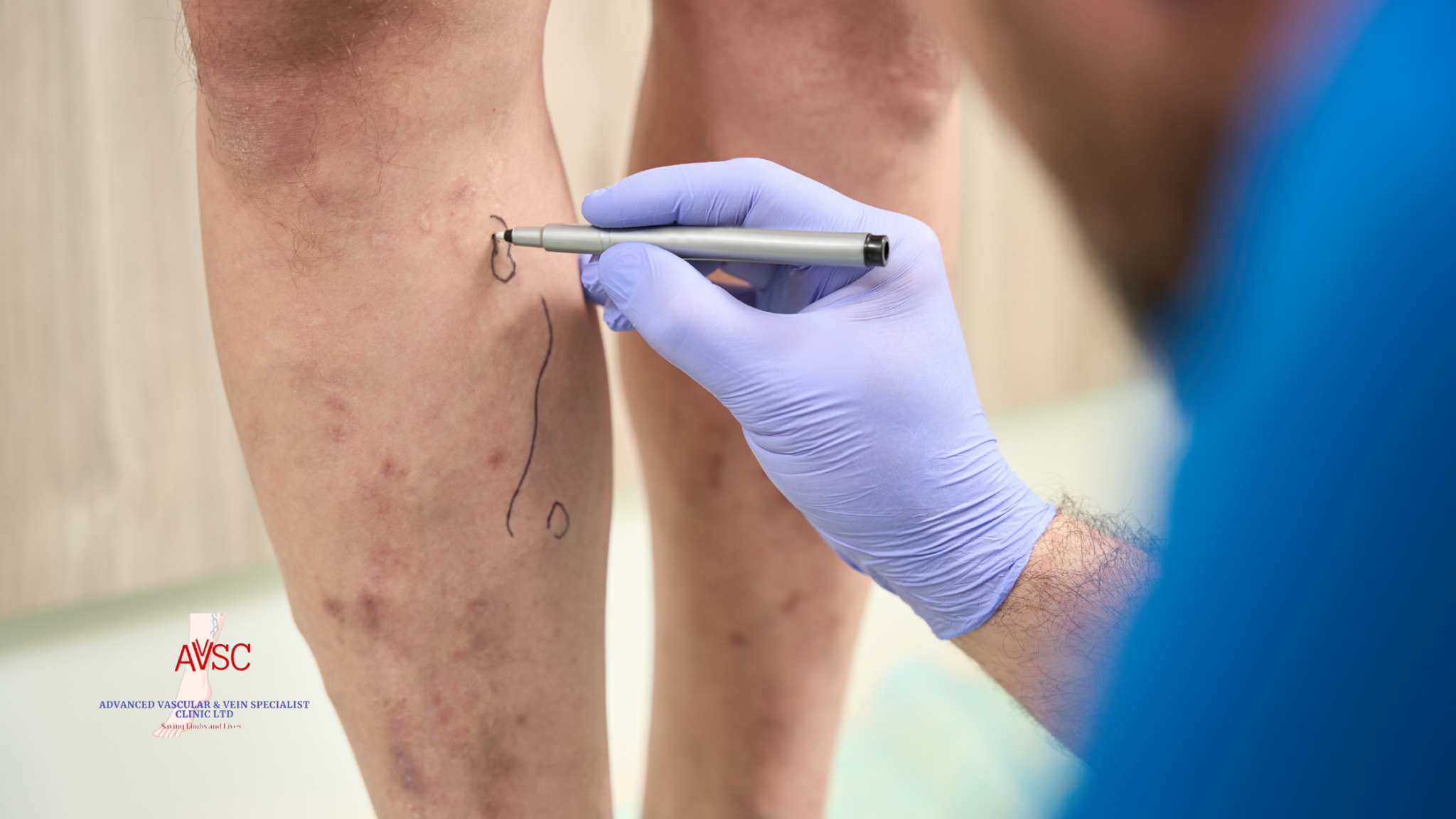Choosing the Right Treatment for Varicose Veins: A Comprehensive Guide ...