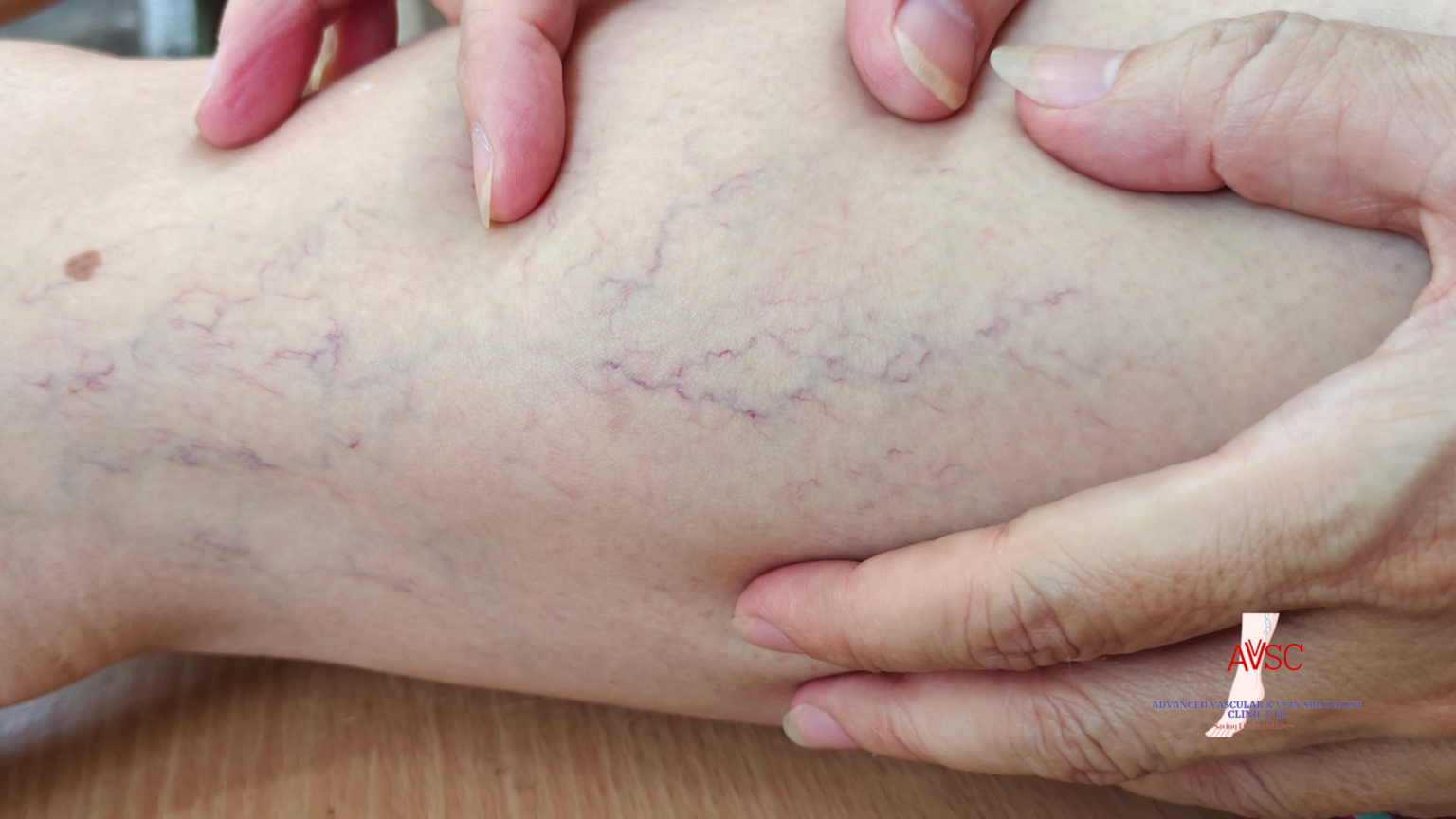 Choosing the Right Treatment for Varicose Veins: A Comprehensive Guide ...